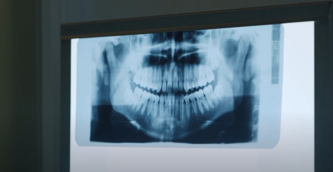Understanding Dental X-Rays